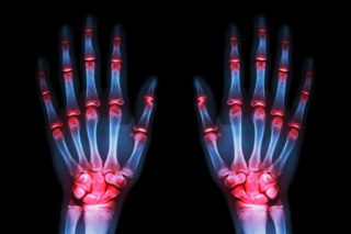 Ankylosing Spondylitis – AZIV Infusion Therapy Center