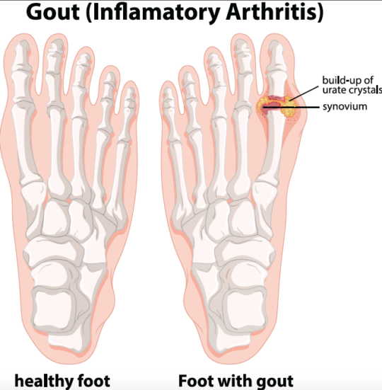 Inflammatory Eye Disease – AZIV Infusion Therapy Center