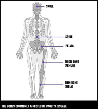Paget’s Disease of the Bone – AZIV Infusion Therapy Center